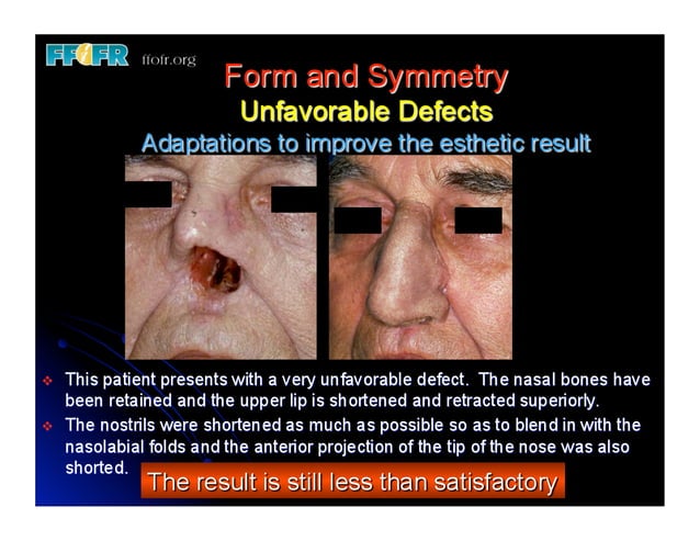 23.restoration of nasal defects | PDF