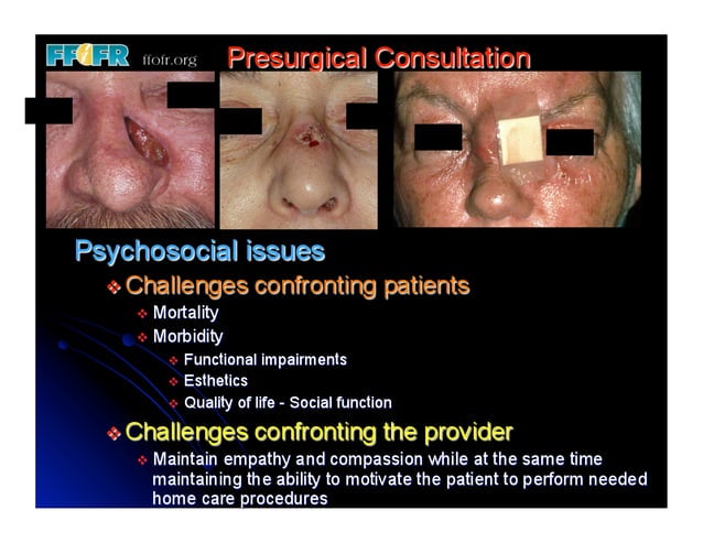 23.restoration of nasal defects | PDF