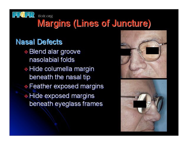 23.restoration of nasal defects | PDF