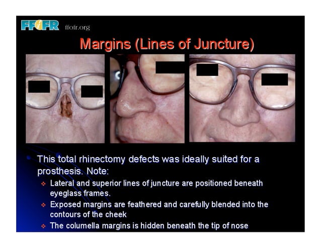 23.restoration of nasal defects | PDF