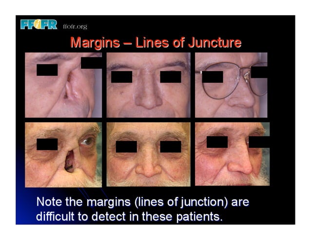 23.restoration of nasal defects | PDF
