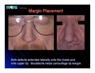 23.restoration of nasal defects | PDF