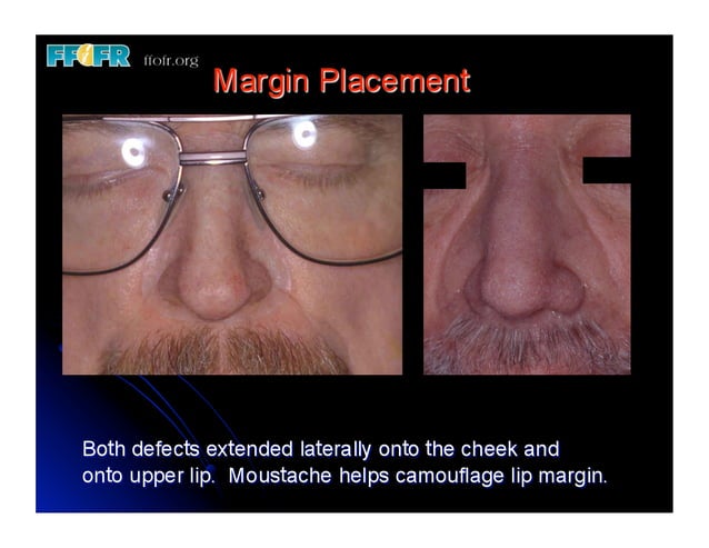 23.restoration of nasal defects | PDF