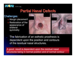 23.restoration of nasal defects | PDF