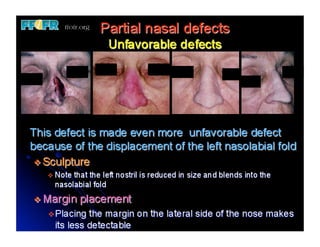 23.restoration of nasal defects | PDF