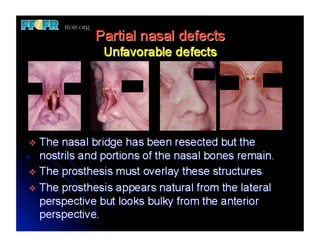 23.restoration of nasal defects | PDF