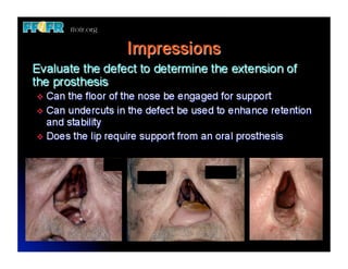 23.restoration of nasal defects | PDF