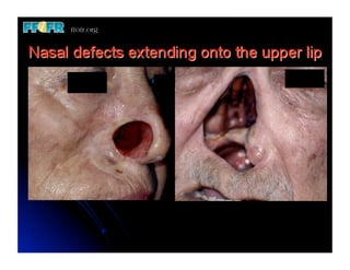 23.restoration of nasal defects | PDF