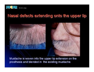 23.restoration of nasal defects | PDF