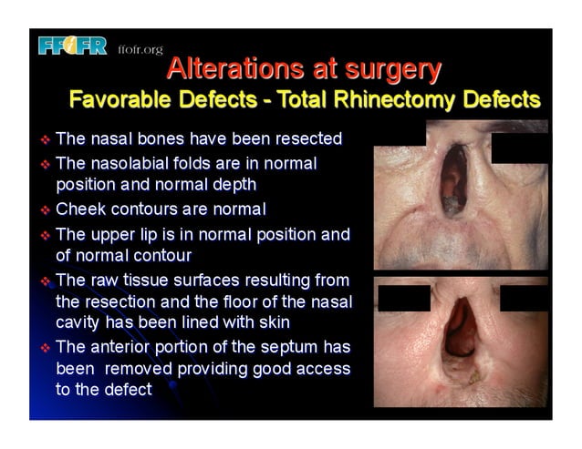 23.restoration of nasal defects | PDF