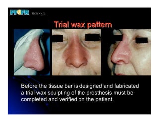 23.restoration of nasal defects | PDF