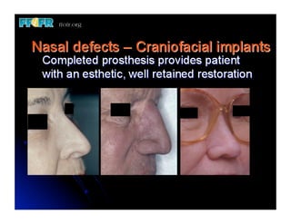 23.restoration of nasal defects | PDF