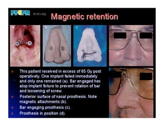 23.restoration of nasal defects | PDF