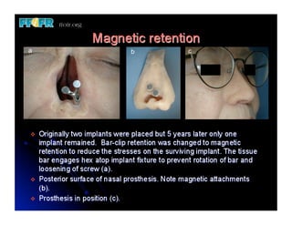 23.restoration of nasal defects | PDF