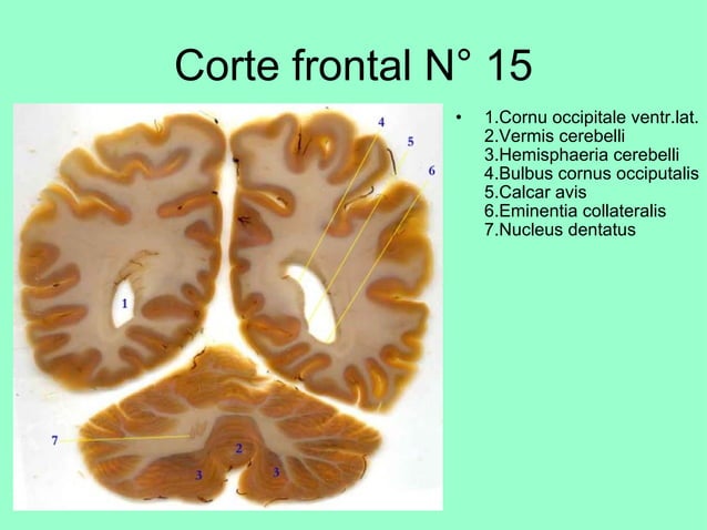 corte coronal de encefalo | PPT