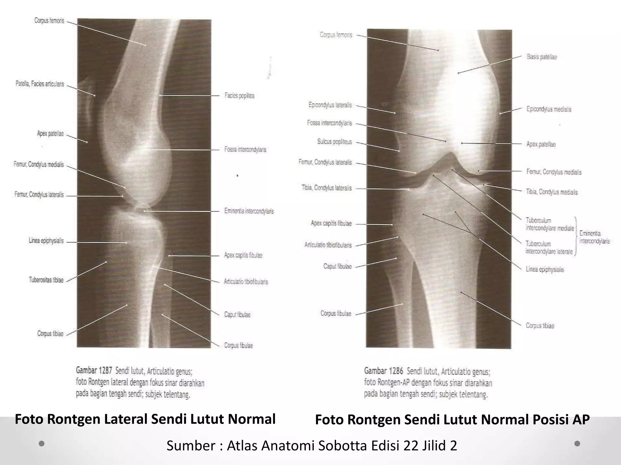 osteoarthritis.ppt