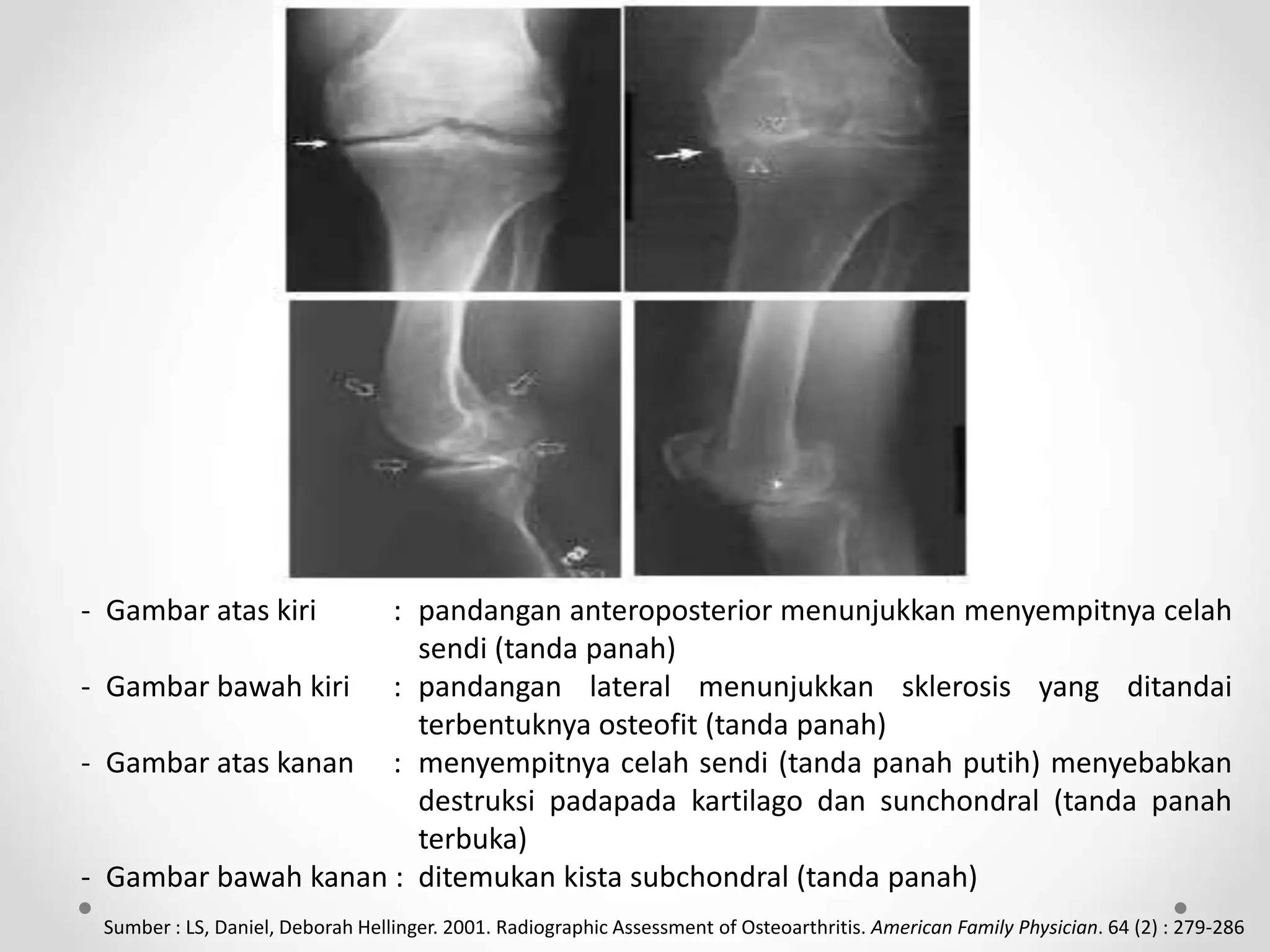 osteoarthritis.ppt