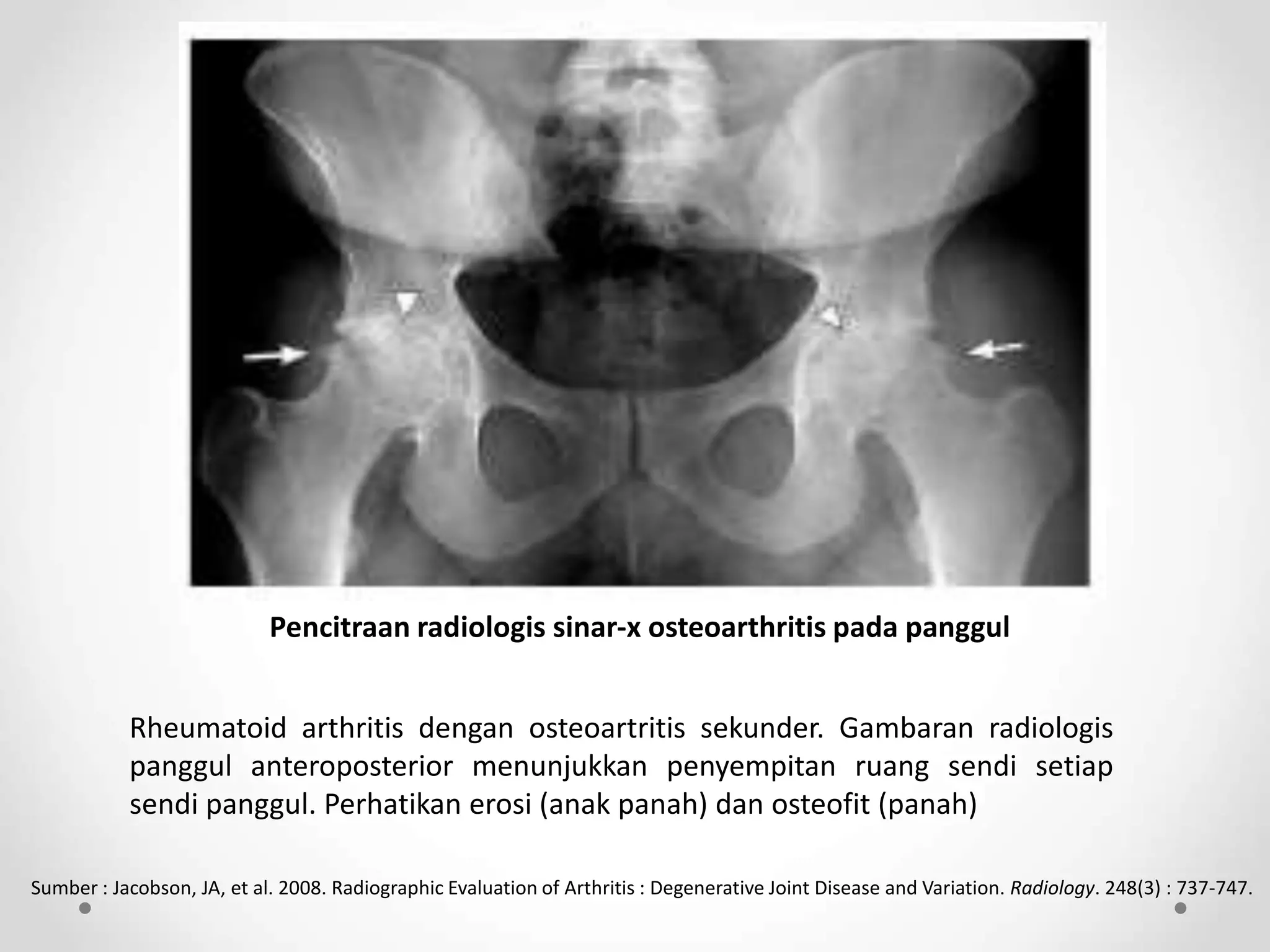 osteoarthritis.ppt