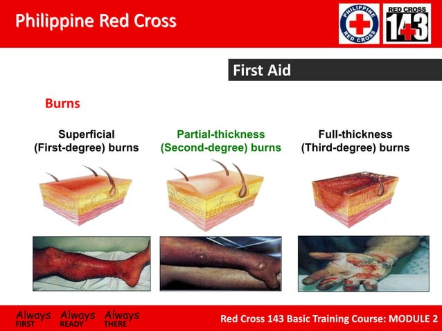 232100753-Ph-Red-Cross-First-Aid-and-BLS.ppt | First Aid | Injuries