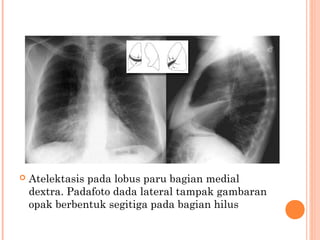 232593414 atelektasis-radiologi-ppt | PPT