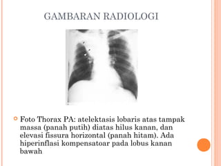 232593414 atelektasis-radiologi-ppt | PPT