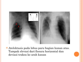 232593414 atelektasis-radiologi-ppt | PPT