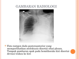 232593414 atelektasis-radiologi-ppt | PPT