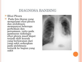 232593414 atelektasis-radiologi-ppt | PPT