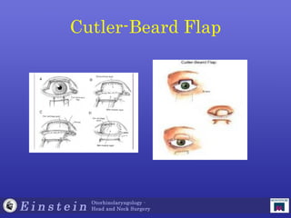 232b Coclia 97 98 Eyelid Reconstruction, Facial Reanimation | PPT
