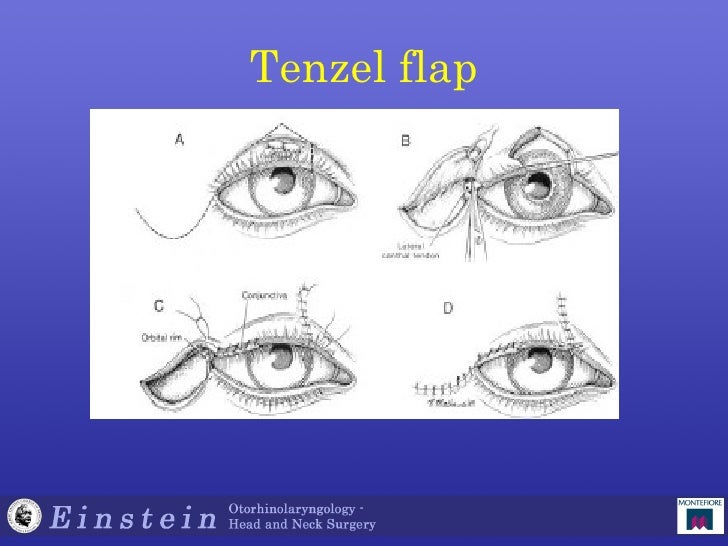 232b Coclia 97 98 Eyelid Reconstruction, Facial Reanimation