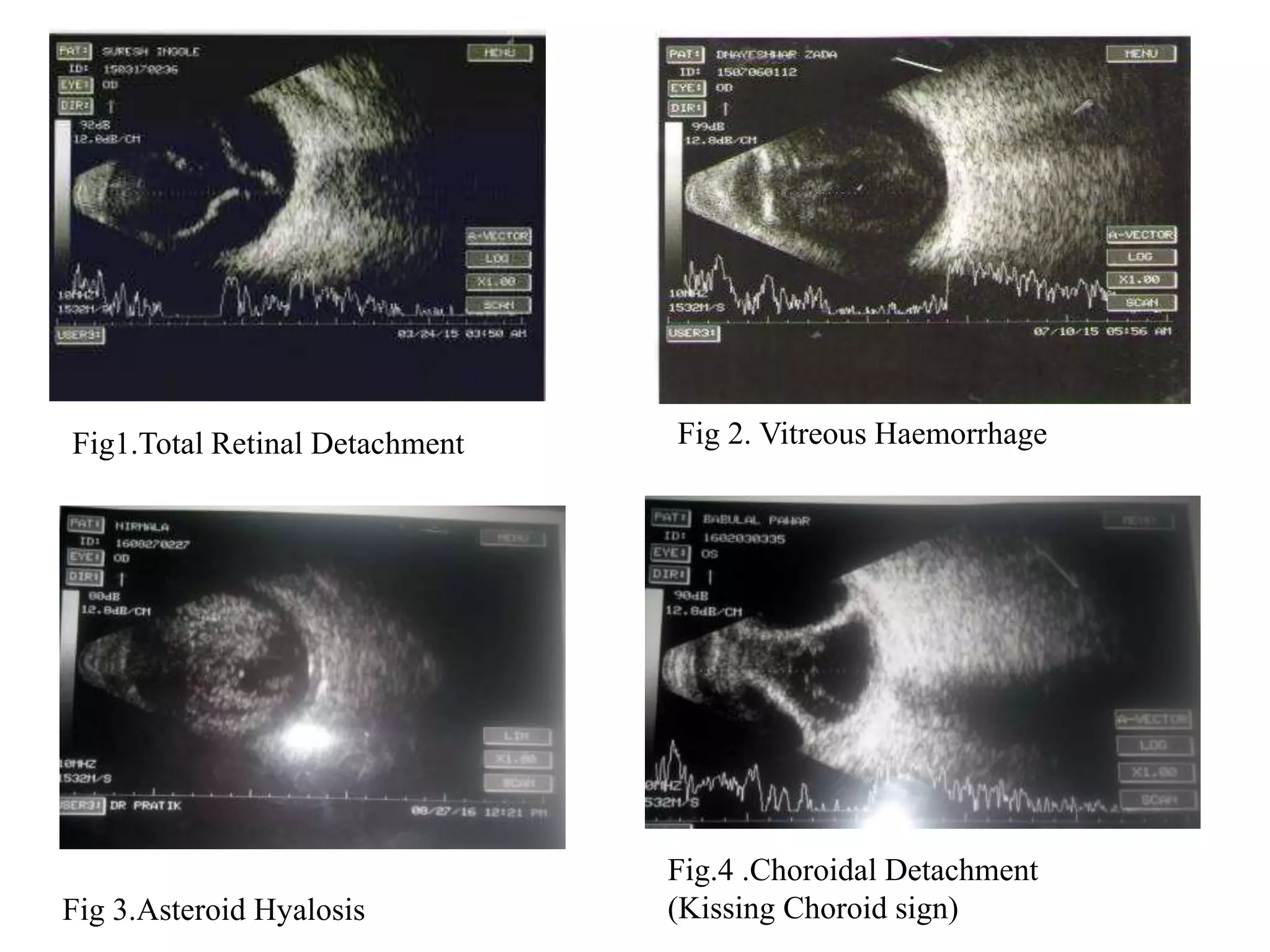 “Study Of B-Scan Ocular Ultrasound In Diagnosing Posterior Segment ...