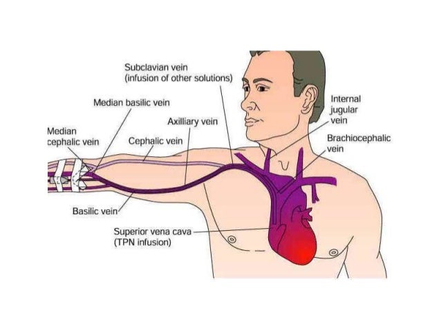 PICC peripherally inserted central venous catheter by Dennis Inyangala