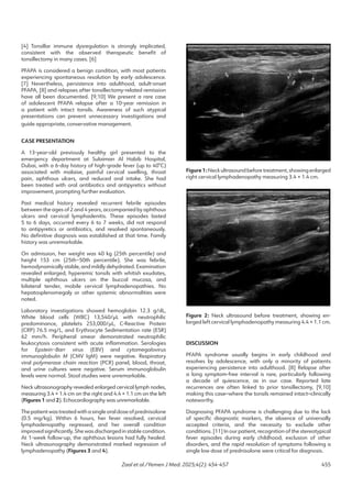 Late Relapse of Periodic Fever, Aphthous Stomatitis, Pharyngitis, and ...