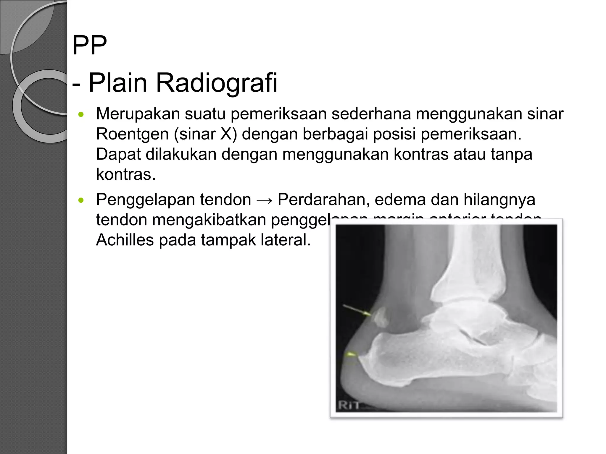 237314131-Yuda-Ruptur-Tendon-Achilles-PPT-Blok-14.pptx