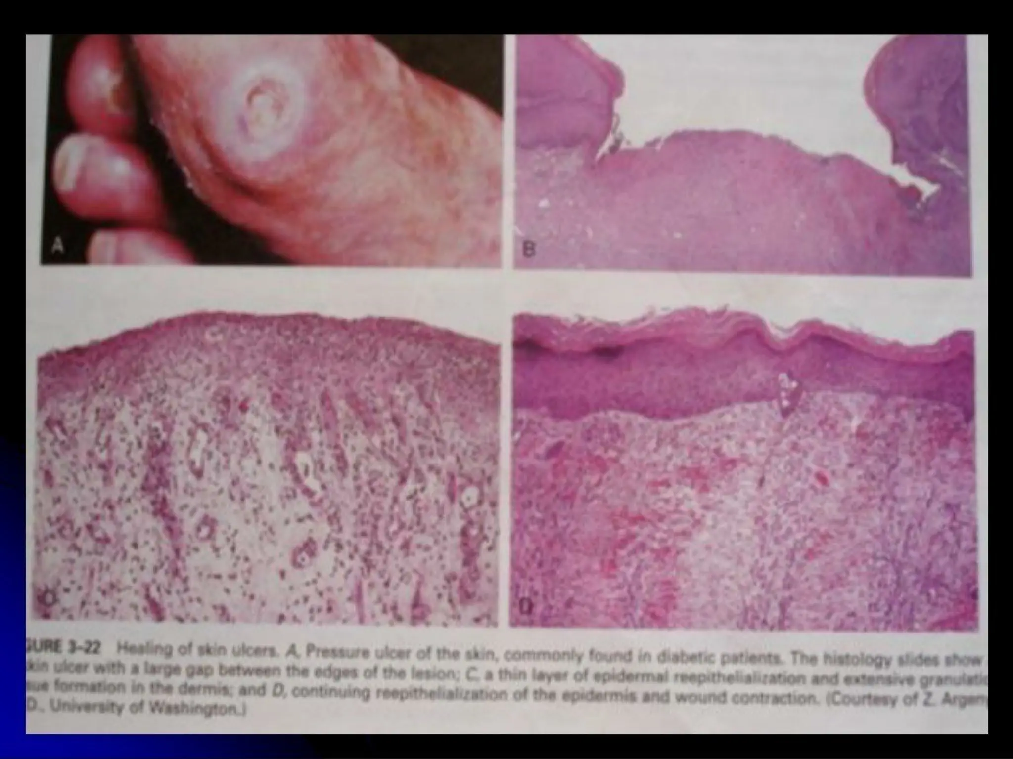 Wound healing process stages 238123310.pptx