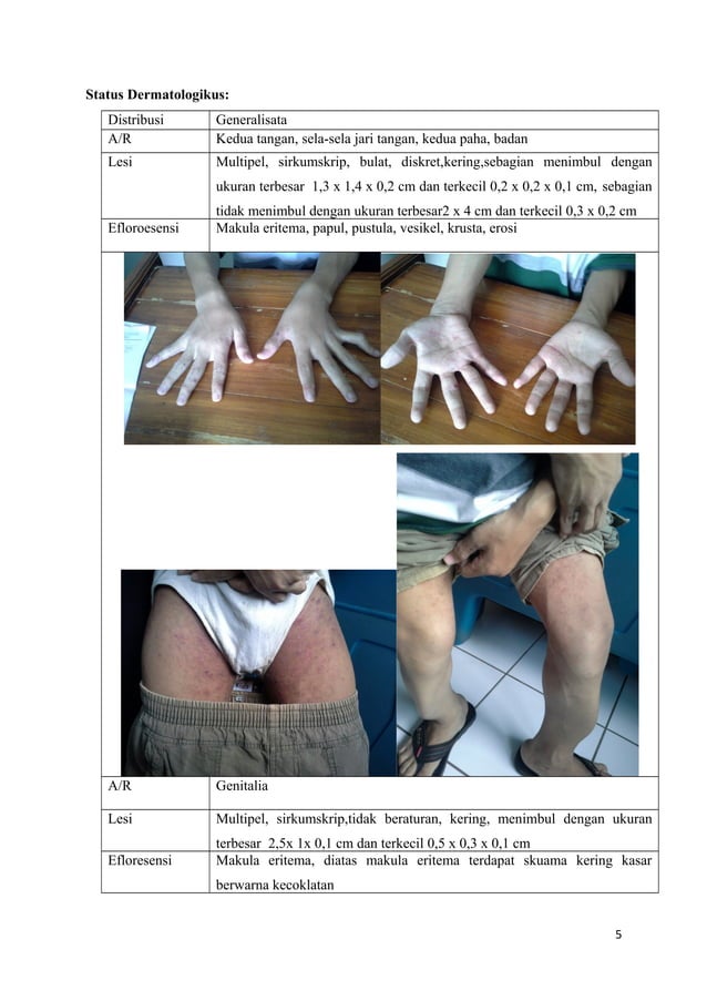 239776755 dr-bowo-lapkas-scabies | DOC