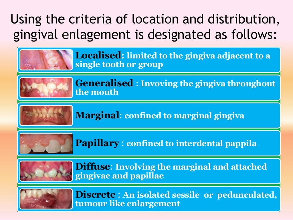 gingival enlargement