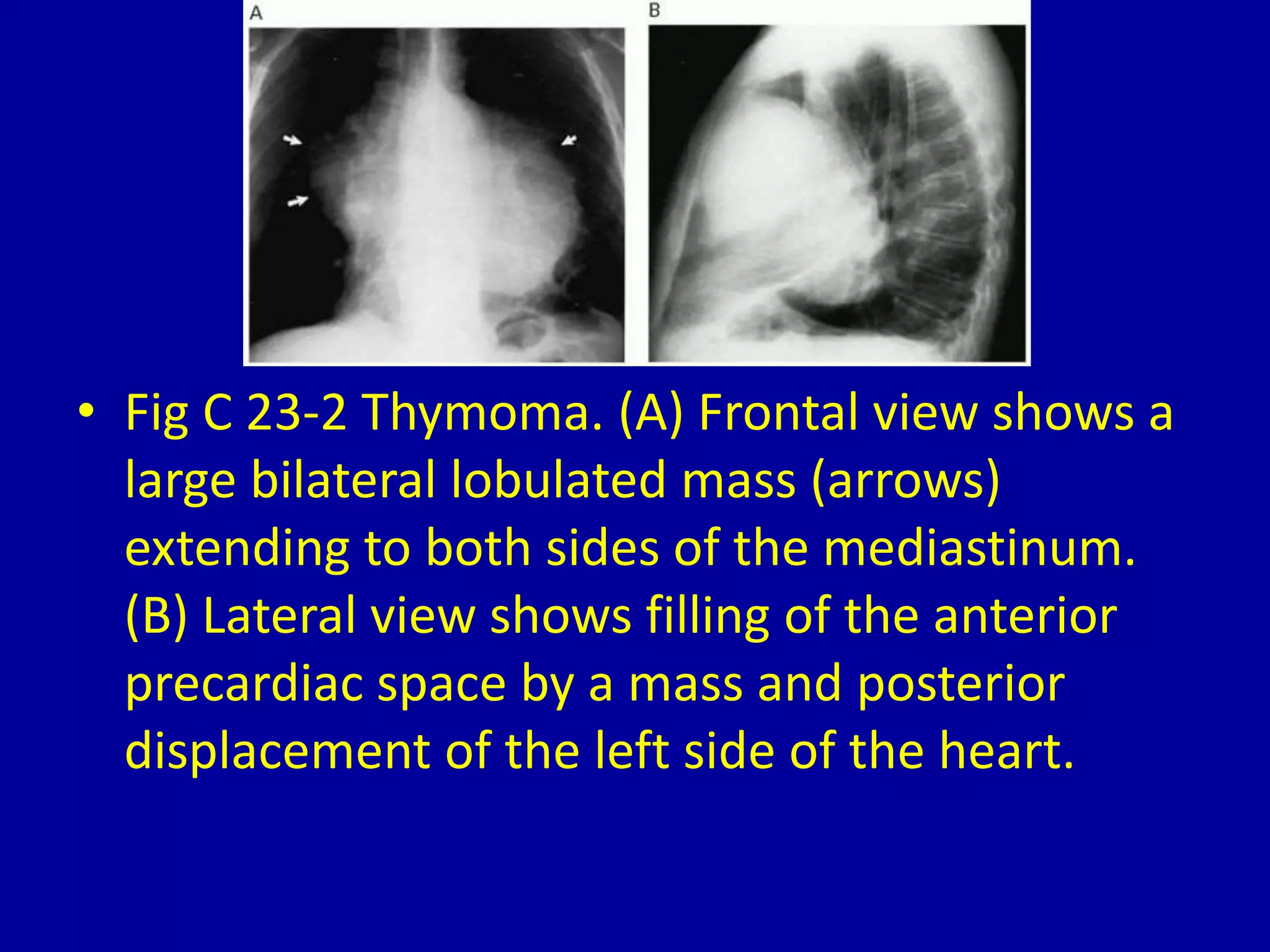 23 anterior mediastinal lesions | PPTX | Thyroid Disorders | Endocrine ...