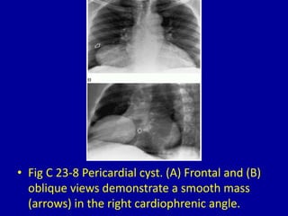 23 anterior mediastinal lesions | PPTX