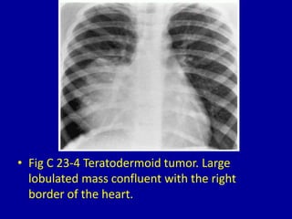 23 anterior mediastinal lesions | PPTX