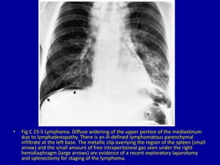 23 anterior mediastinal lesions | PPTX