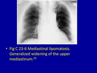 23 anterior mediastinal lesions | PPTX