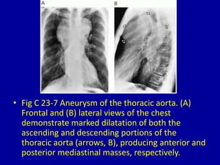 23 anterior mediastinal lesions | PPTX
