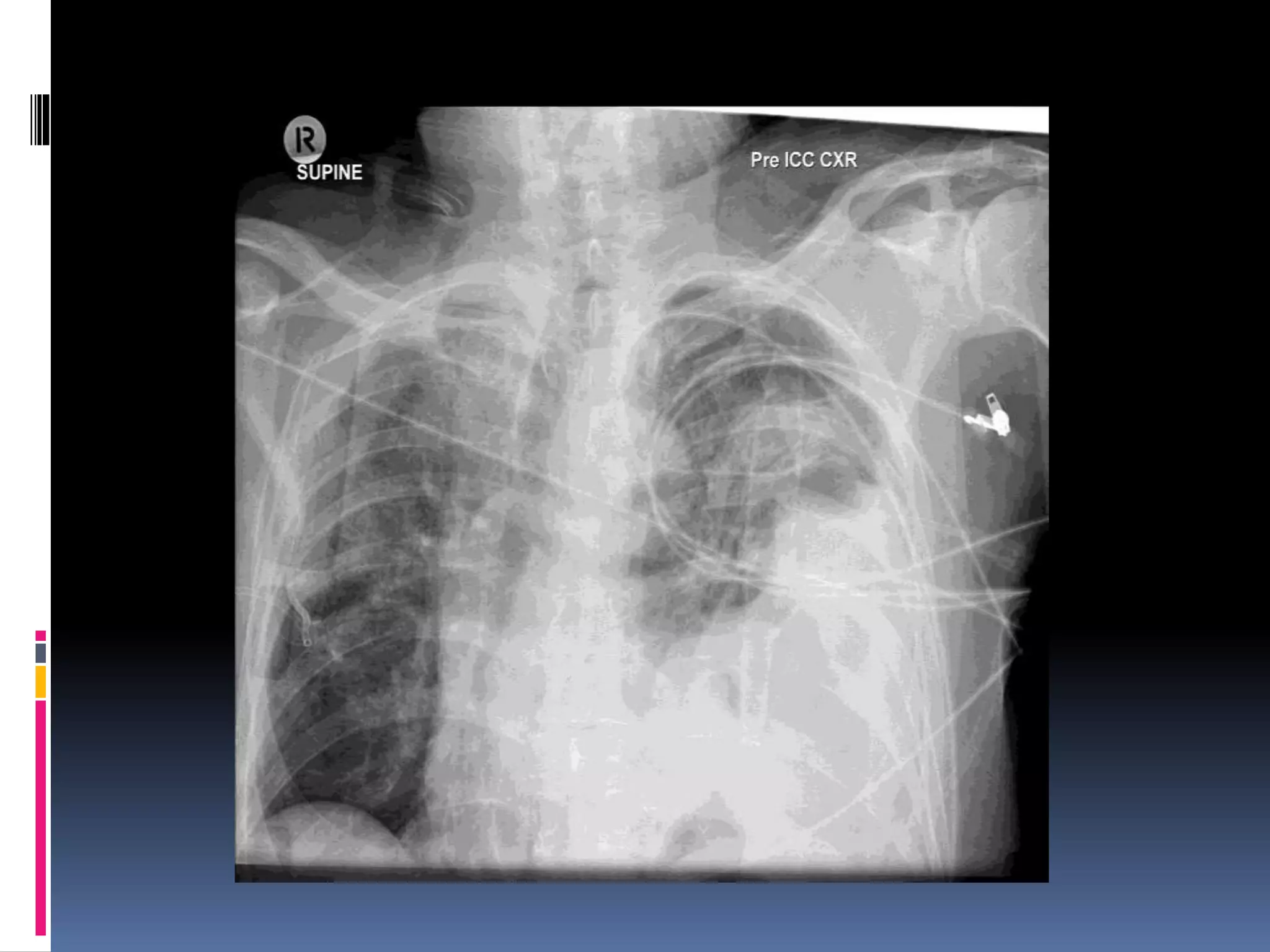 JUNCTIONAL ZONES OF TORSO TRAUMA | PPTX