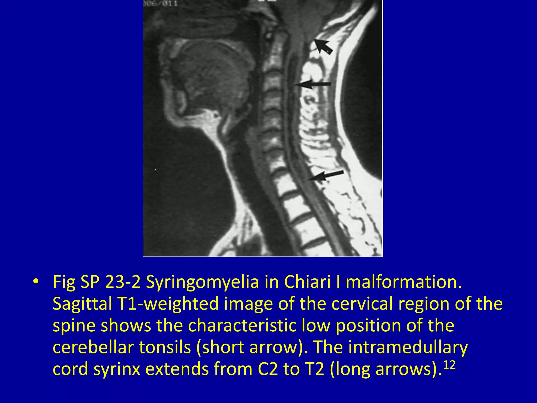 23 congenital anomalies of the spine on magnetic | PPTX