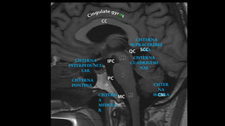 HERNIACION CEREBRAL EXPOSICION.......... | PPTX