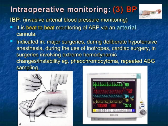 intraoperative monitoring | PPT