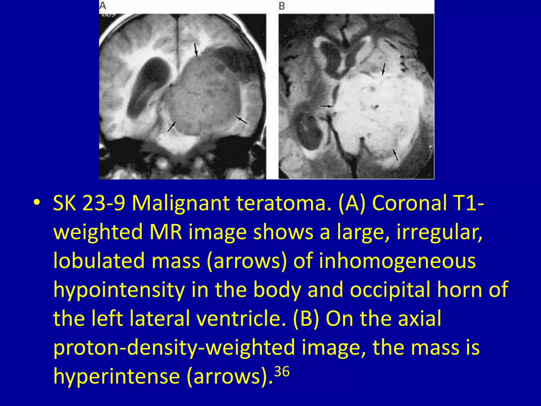 23 intraventricular masses | PPTX
