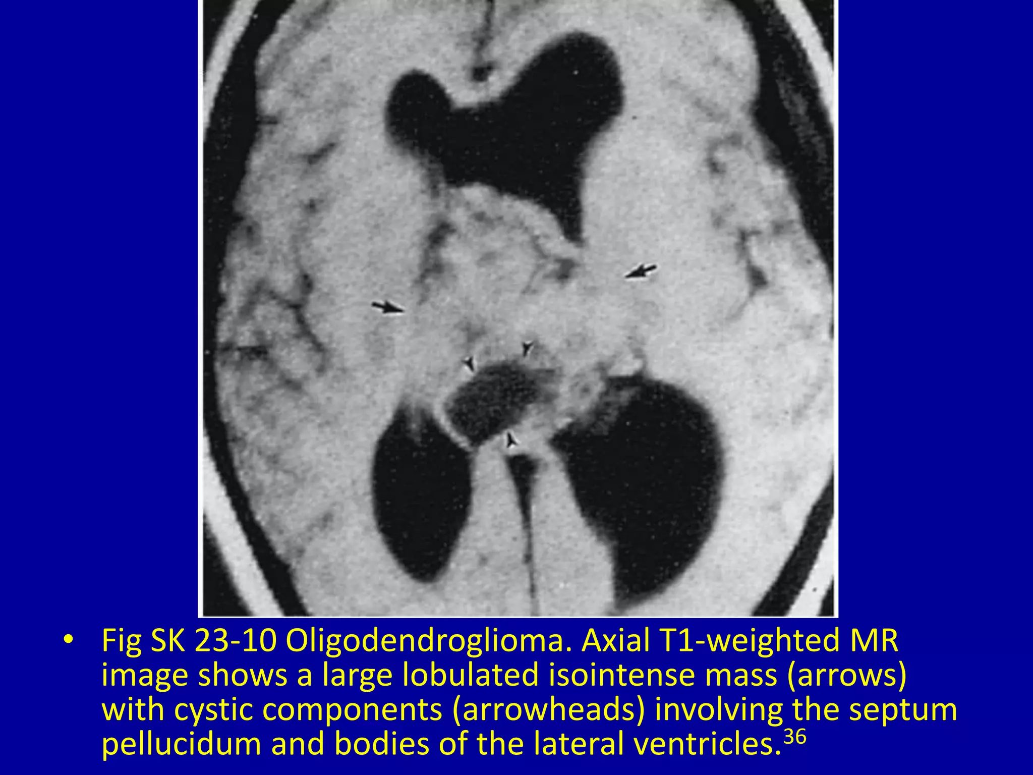 23 intraventricular masses | PPTX