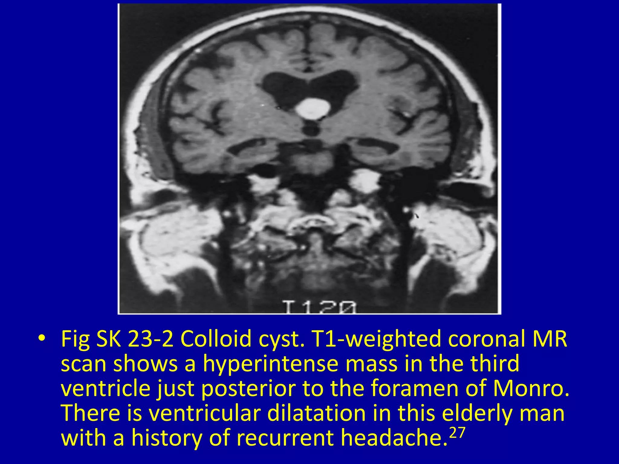 23 intraventricular masses | PPTX